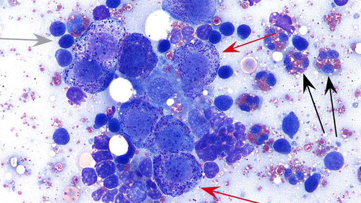 Image Gallery: Lymph Node Cytology | Clinician's Brief