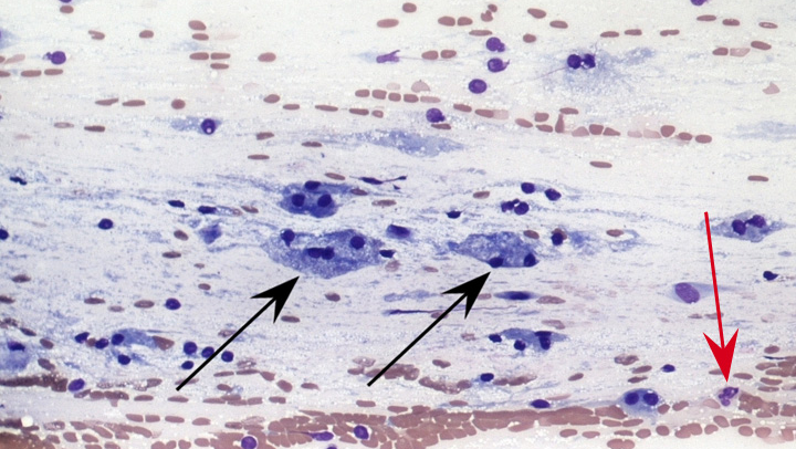Image Gallery: Lymph Node Cytology | Clinician's Brief