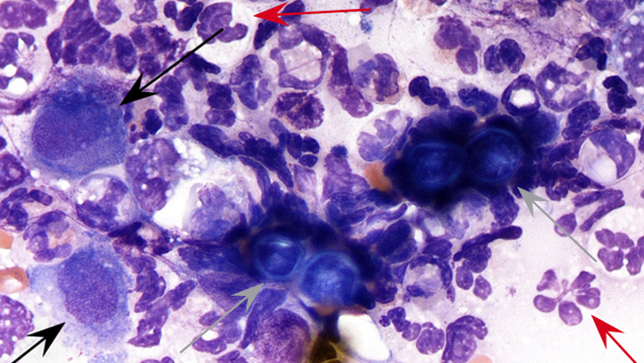 Image Gallery: Lymph Node Cytology | Clinician's Brief