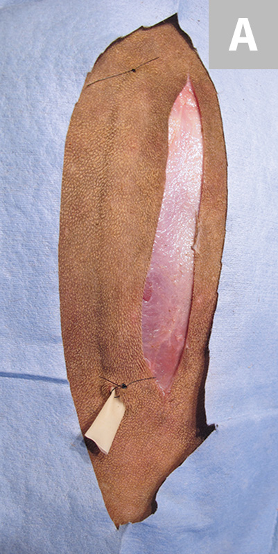 Wound Drain Placement | Clinician's Brief