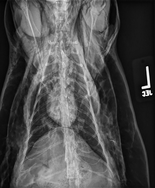 Pneumomediastinum | Clinician's Brief
