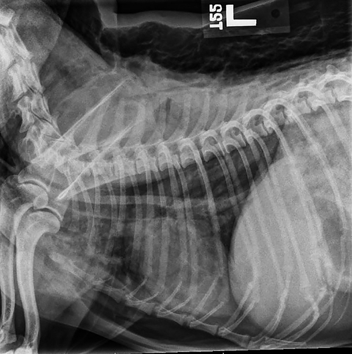 Pneumomediastinum | Clinician's Brief