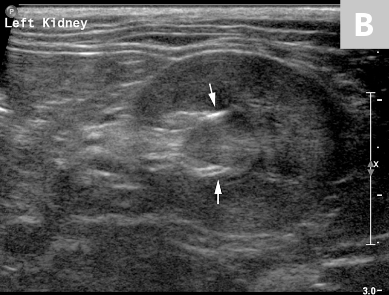 Imaging of Calculi of the Urinary System | Clinician's Brief