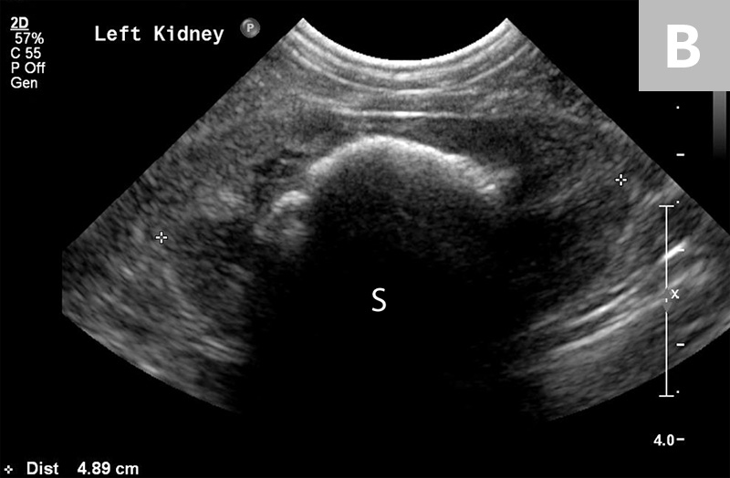 Imaging of Calculi of the Urinary System | Clinician's Brief