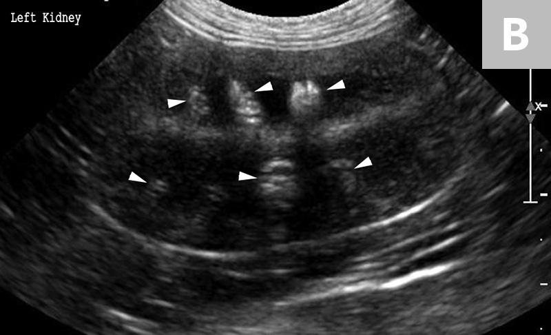 Imaging of Calculi of the Urinary System | Clinician's Brief