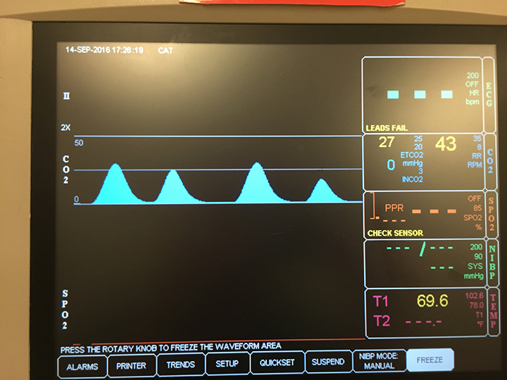 Image Gallery: Capnography | Clinician's Brief