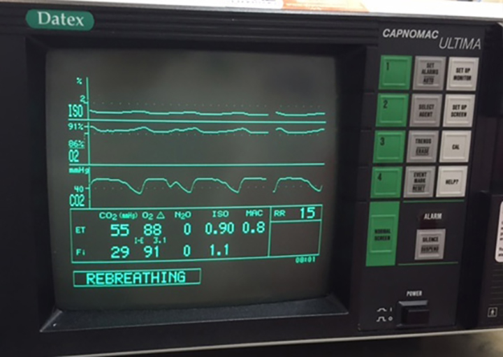 Image Gallery: Capnography | Clinician's Brief