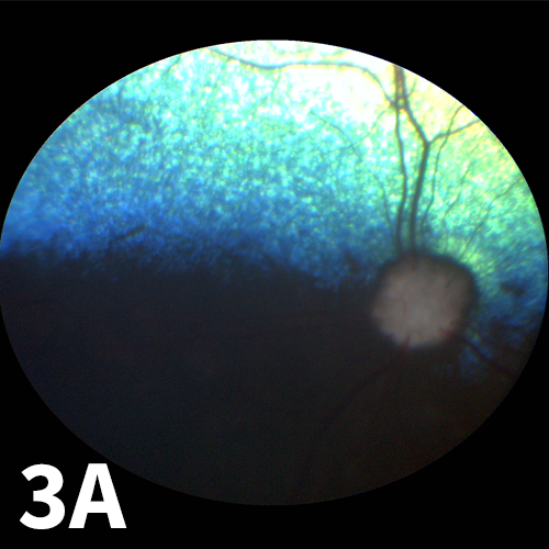 Top 5 Classifications of Blindness | Clinician's Brief