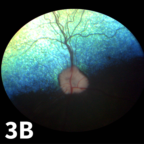 Top 5 Classifications of Blindness | Clinician's Brief