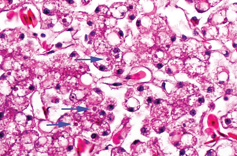 Boid Inclusion Body Disease | Clinician's Brief