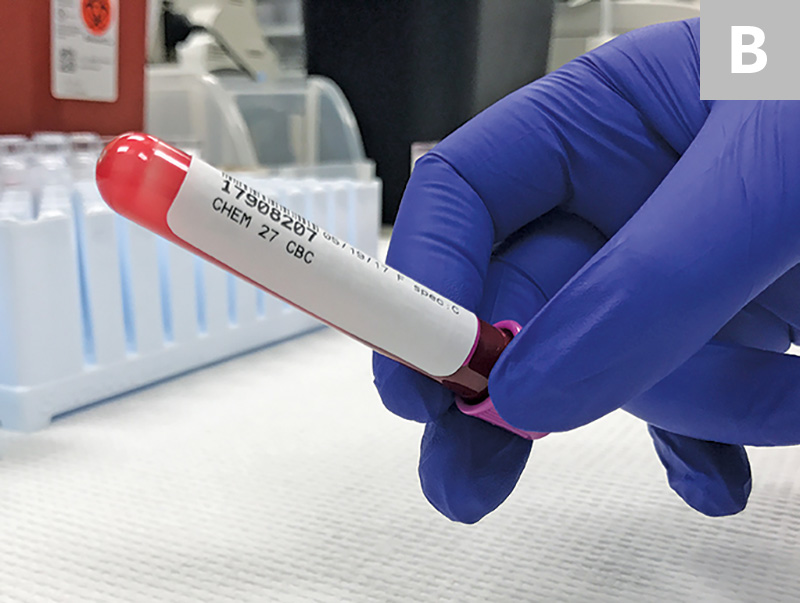 Blood Smear Preparation | Clinician's Brief