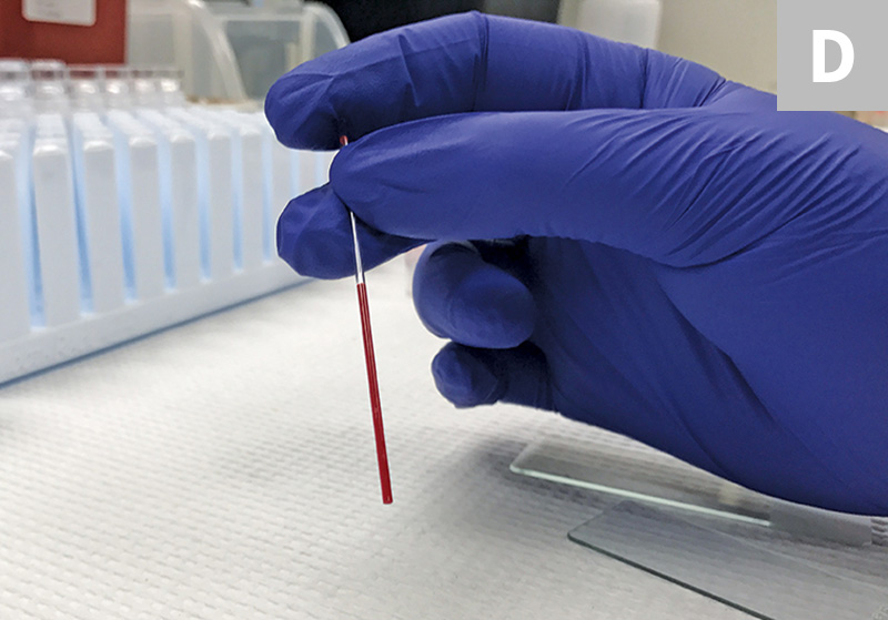 Blood Smear Preparation | Clinician's Brief