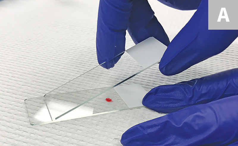 Blood Smear Preparation | Clinician's Brief