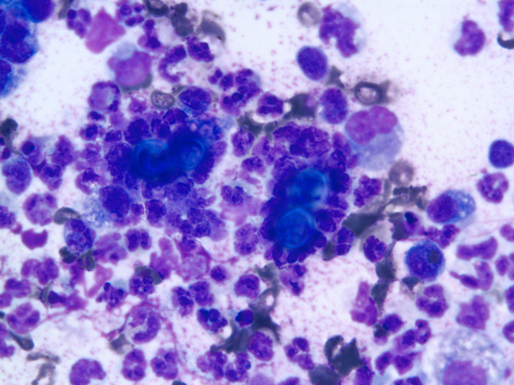 Quiz: Systemic Fungal Diseases | Clinician's Brief