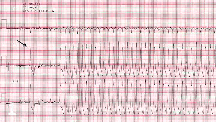 Ventricular Tachycardia | Clinician's Brief