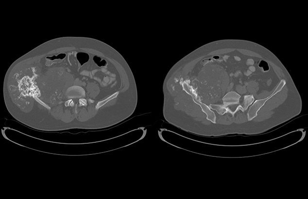 Sarcoma in Animals and Humans | Clinician's Brief