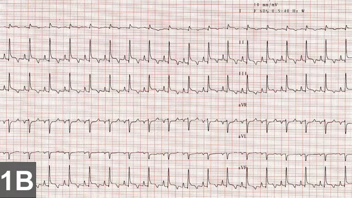 Top 5 Arrhythmias (Abnormal Heartbeat Rhythms) in Dogs & Cats ...