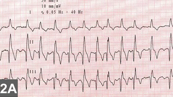 Top 5 Arrhythmias (Abnormal Heartbeat Rhythms) in Dogs & Cats ...