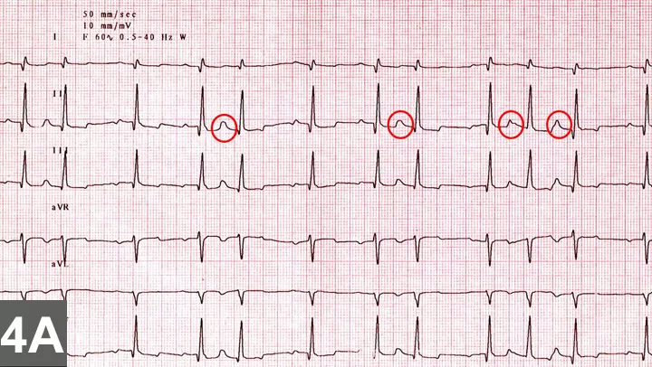 Top 5 Arrhythmias (Abnormal Heartbeat Rhythms) in Dogs & Cats ...