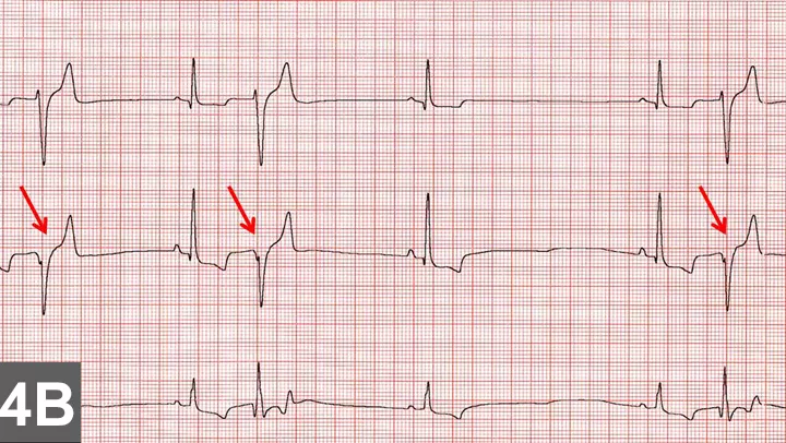 Top 5 Arrhythmias (Abnormal Heartbeat Rhythms) in Dogs & Cats ...