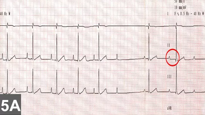 Top 5 Arrhythmias (Abnormal Heartbeat Rhythms) in Dogs & Cats ...