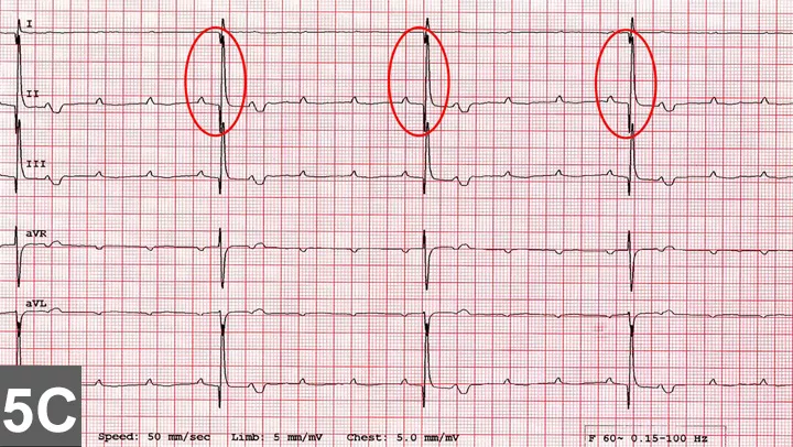 Top 5 Arrhythmias (Abnormal Heartbeat Rhythms) in Dogs & Cats ...