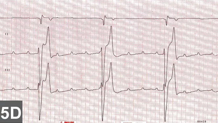 Top 5 Arrhythmias (Abnormal Heartbeat Rhythms) in Dogs & Cats ...