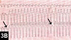 Top 5 Arrhythmias (Abnormal Heartbeat Rhythms) in Dogs & Cats ...
