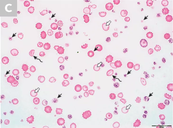 Blood Smear Platelet Evaluation & Interpretation | Clinician's Brief